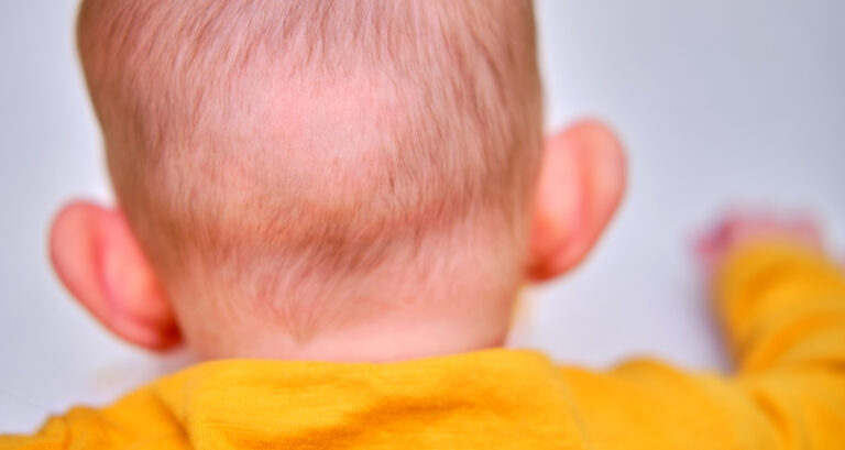 Causes of Hairloss - American Hair Loss Association